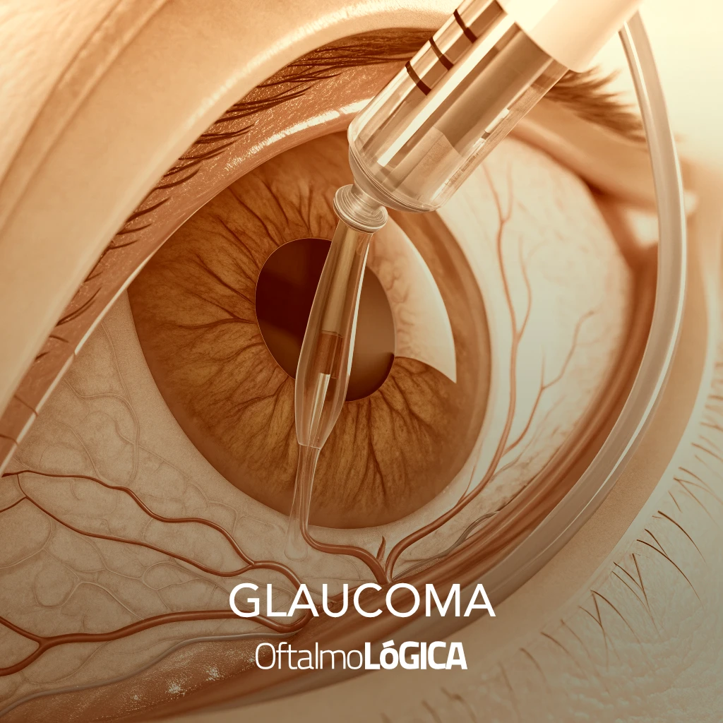 Glaucoma — Manejo Médico y Quirúrgico del Glaucoma – Oftalmológica